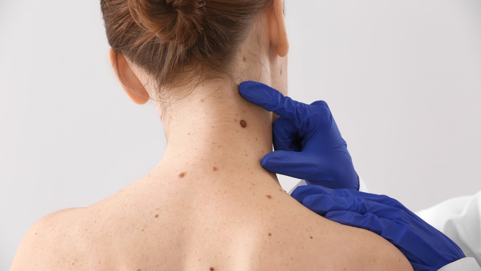 Odstranjevanje znamenj – Hitra in varna odstranitev znamenja